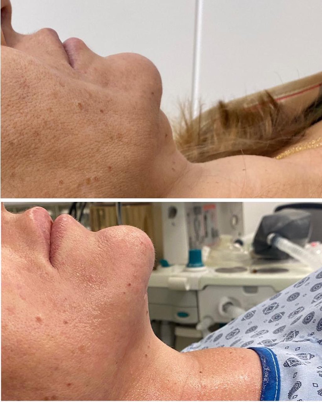 Neck Lift in Turkey - Op. Dr. Erkan Dodanlı